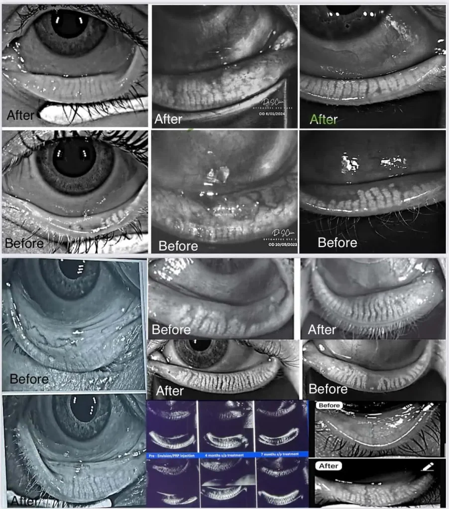 Before And After Eye Care Results | Hoang Optometry Patient Gallery